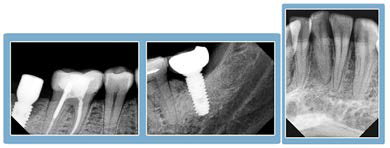 Hybrid Portable X-Ray System– LSR Healthcare